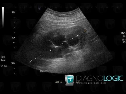 Radiology case : Hydronephrosis (US) - Diagnologic