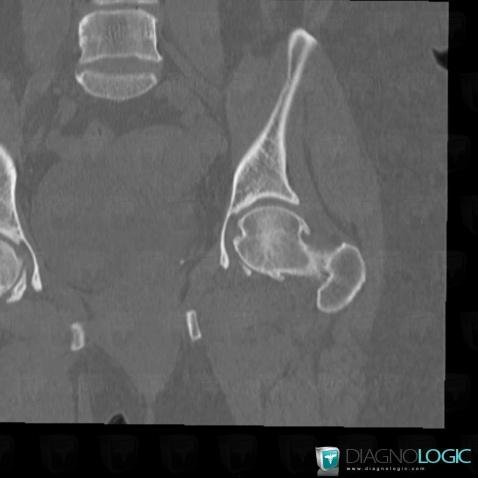 Radiology case : Infectious arthritis (X rays ,CT) - Diagnologic