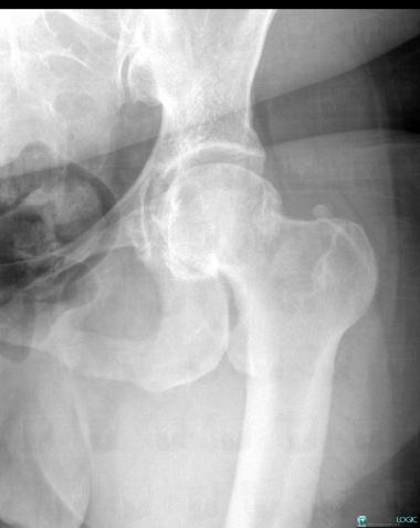Radiology case : Infectious arthritis (X rays ,CT) - Diagnologic