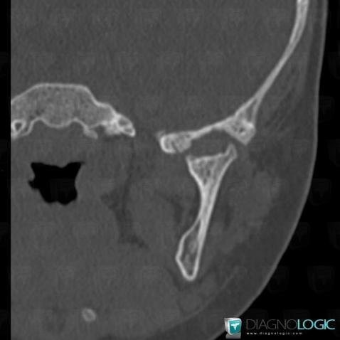 Radiology case : Infectious arthritis (MRI ,CT) - Diagnologic
