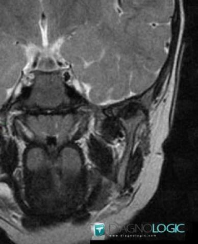 Radiology case : Infectious arthritis (MRI ,CT) - Diagnologic