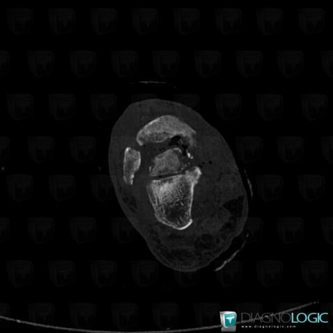 Radiology case : Infectious arthritis (CT) - Diagnologic