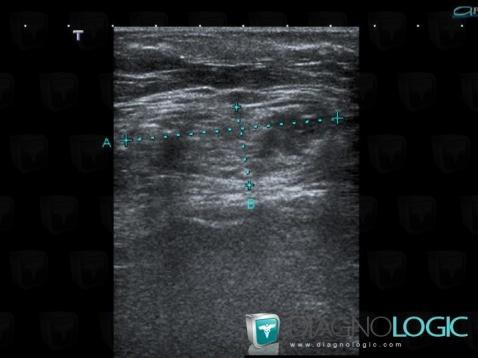 Radiology case : Inguinal hernia (US ,CT) - Diagnologic