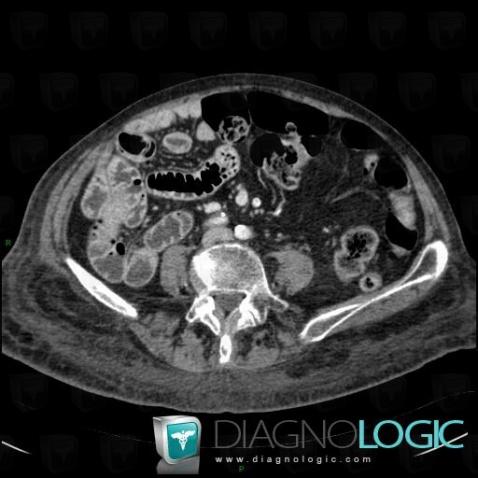 Radiology case : Amyloidosis (CT) - Diagnologic