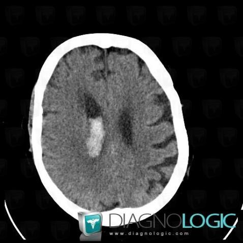 Radiology case : Hematoma (CT ,MRI) - Diagnologic
