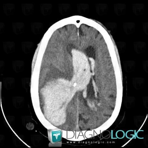 Radiology case : Hematoma (CT) - Diagnologic