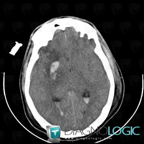 Radiology case : Hematoma (CT) - Diagnologic