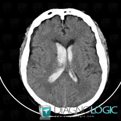 Radiology case : Subdural hematoma (CT) - Diagnologic