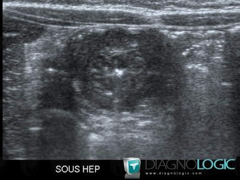 Cas radiologie : Invagination intestinale (Echographie ,Radio ...