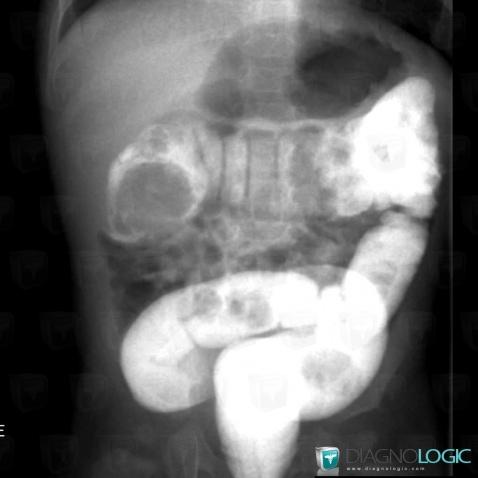 Cas radiologie : Invagination intestinale (Echographie ,Radio ...