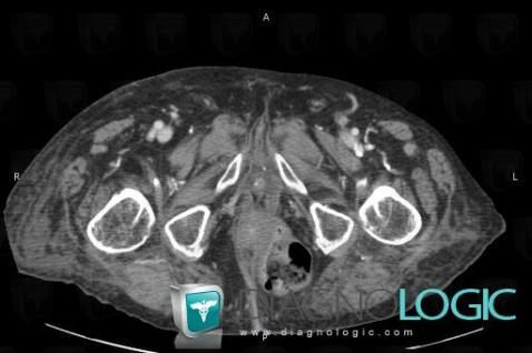 Radiology case : Ischio rectal hernia (CT) - Diagnologic