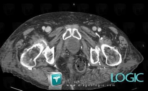Radiology case : Ischio rectal hernia (CT) - Diagnologic