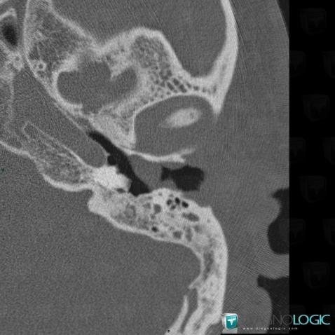 Radiology case : Keratosis obturans (CT) - Diagnologic