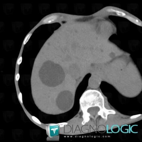 Kyste Biliaire Kystes Biliaires ScienceDirect