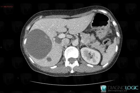 Kyste Biliaire Kystes Biliaires ScienceDirect