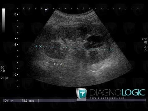 Cas radiologie : Kyste à contenu protéique (IRM ,Echographie) - Diagnologic