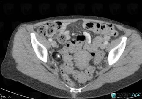 Cas radiologie : Kyste dermoïde (Scanner) - Diagnologic