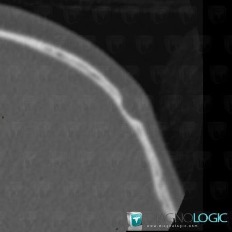 Cas radiologie : Kyste dermoïde (Scanner) - Diagnologic