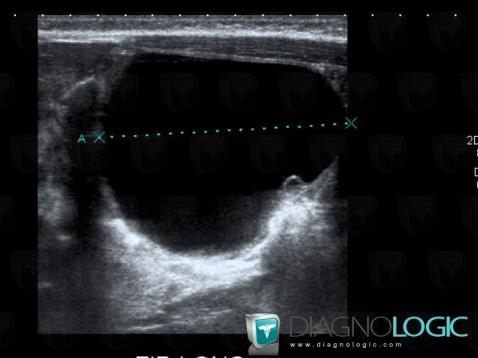 Cas radiologie : Kyste fonctionnel (Echographie) - Diagnologic