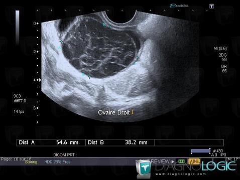 Cas radiologie : Kyste fonctionnel hémorragique (Echographie) - Diagnologic