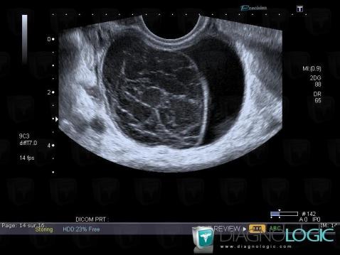 Cas radiologie : Kyste fonctionnel hémorragique (Echographie) - Diagnologic