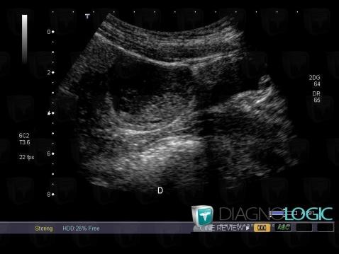 Cas radiologie : Kyste fonctionnel hémorragique (Echographie) - Diagnologic