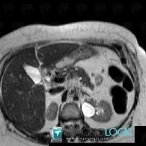 Cas radiologie : Kyste (Scanner ,IRM) - Diagnologic