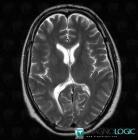 Kyste du septum pellucidum (IRM ,Scanner) - Diagnologic