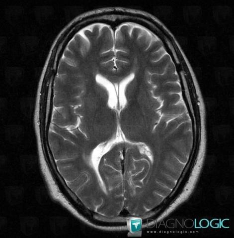 Cas radiologie : Sclérose en plaques (IRM) - Diagnologic