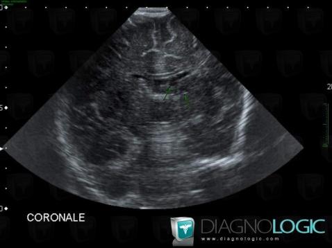 Cas radiologie : Kyste sous épendymaire (Echographie) - Diagnologic