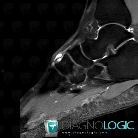 Cas radiologie : Kyste synovial (IRM) - Diagnologic