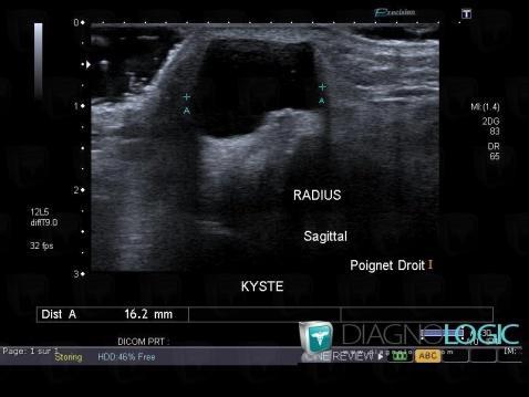 Cas radiologie : Kyste synovial (Radio ,Echographie) - Diagnologic