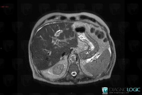 Cas radiologie : Kystes péri biliaires (IRM) - Diagnologic