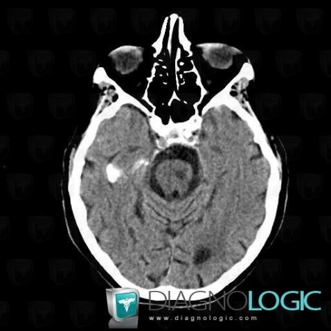 Radiology case : Lacunar infarct (CT) - Diagnologic