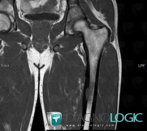 Radiology case : Langerhans cell histiocytosis (CT ,MRI) - Diagnologic