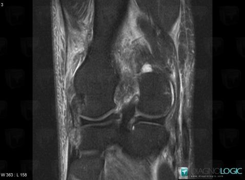 Radiology case : Contusion (MRI) - Diagnologic