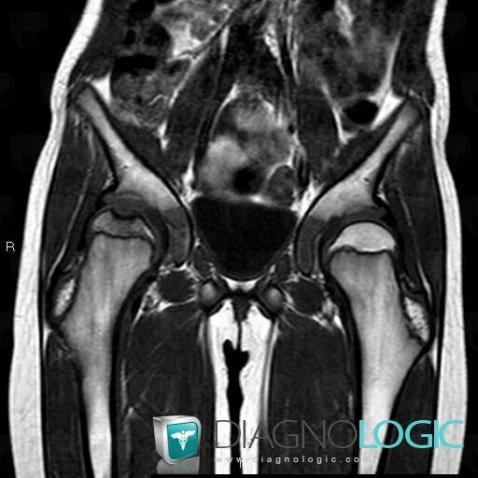 Radiology case : Legg-Perthes disease (MRI) - Diagnologic