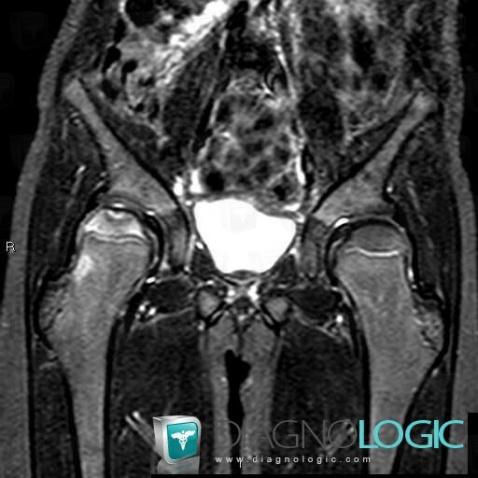 Radiology case : Legg-Perthes disease (MRI) - Diagnologic