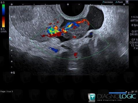 Cas radiologie : Léiomyome (Echographie) - Diagnologic