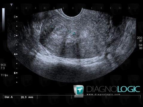 Cas radiologie : Léiomyome (Echographie) - Diagnologic