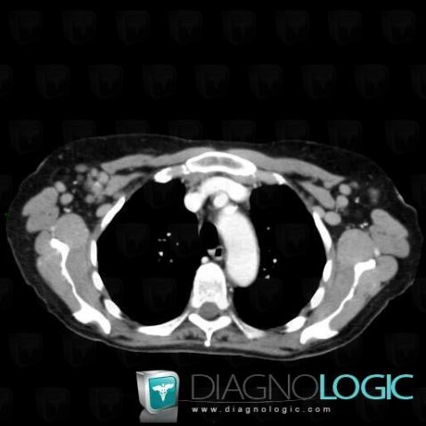 Radiology case : Leukemia (CT) - Diagnologic