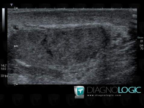 Radiology case : Leydig cell tumor (US) - Diagnologic