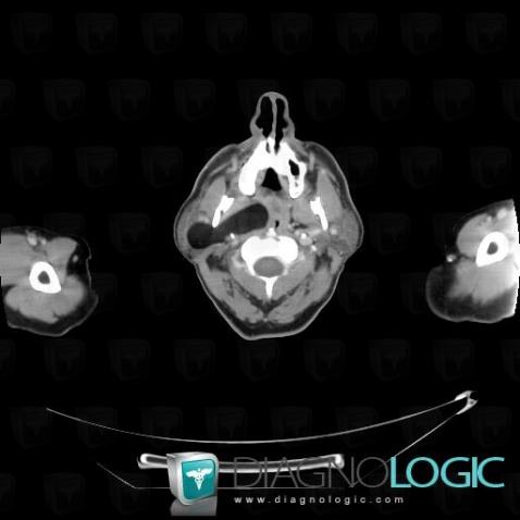 Radiology case : Lipoma (CT) - Diagnologic