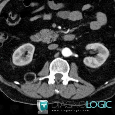 Radiology case : Lipoma (MRI ,CT) - Diagnologic