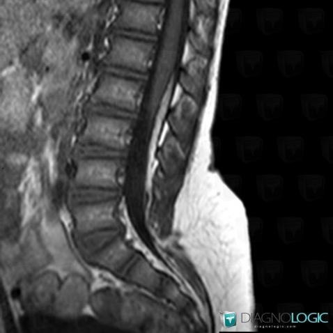 Cas radiologie : Lipome (IRM) - Diagnologic