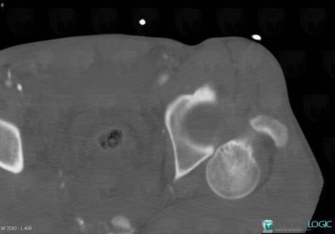Cas radiologie : Luxation (Scanner) - Diagnologic