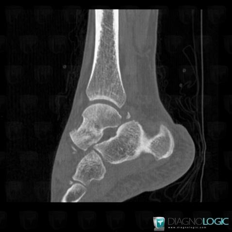 Cas radiologie : Fracture (Scanner) - Diagnologic