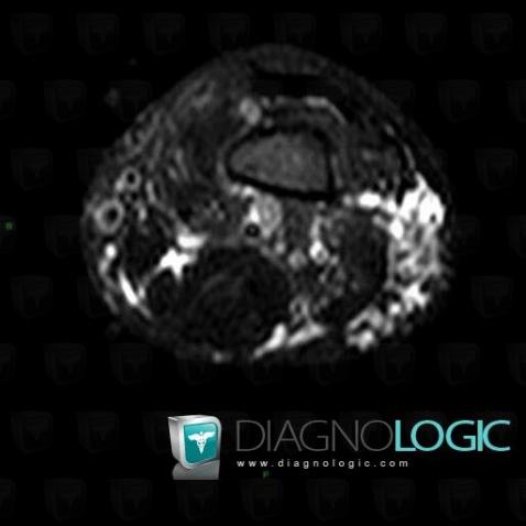 Cas radiologie : Lymphangiome (Echographie ,IRM) - Diagnologic