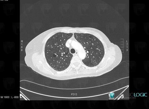 Radiology case : Lymphocytic interstitial pneumonitis (CT) - Diagnologic