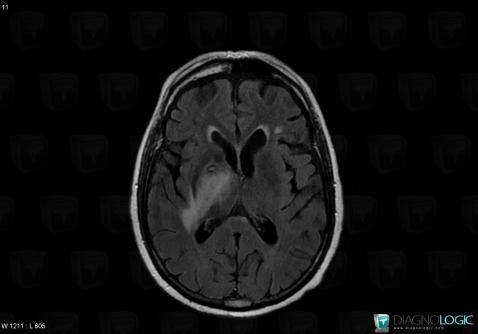 Radiology case : Lymphoma (MRI) - Diagnologic